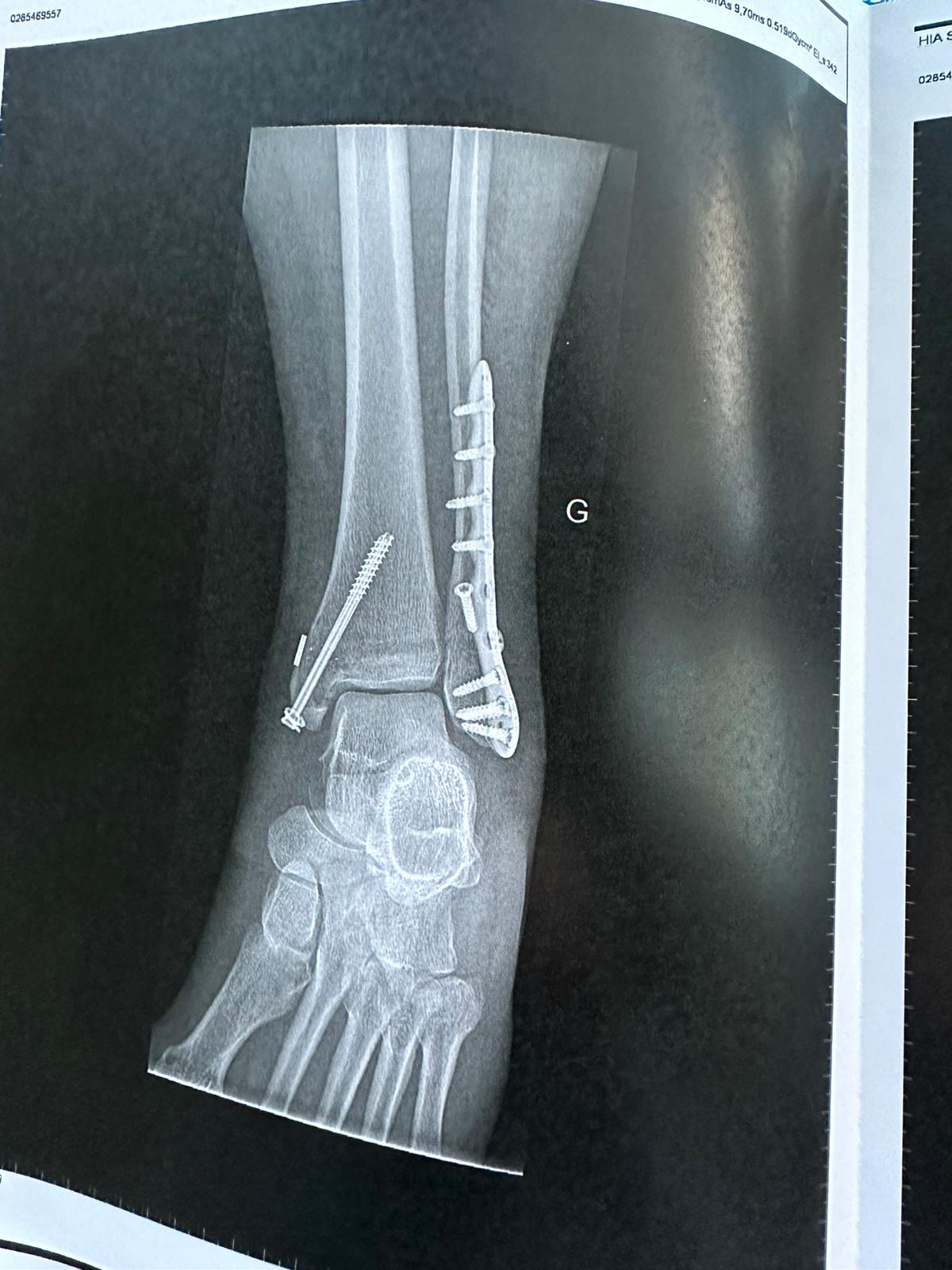 Fractures de cheville – Centre Hospitalier de Soissons