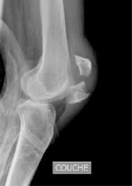 Fracture de la rotule – Chirurgie Orthopédique / Traumatologie