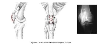 Fracture de la rotule – Chirurgie Orthopédique / Traumatologie