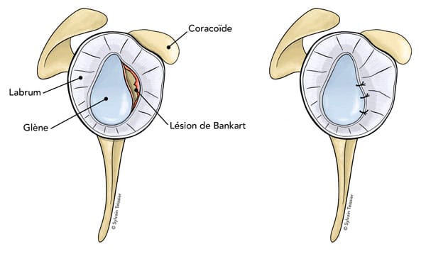 Instabilité de l’épaule – Centre Hospitalier de Soissons