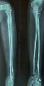 Fracture de la diaphyse des 2 os de l’avant bras – Centre Hospitalier ...